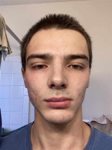 2 5 Month Progress 0 05 Tret Doxycycline R Tretinoin