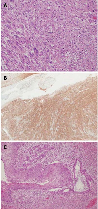 Pathologic Images A Pleomorphic Spindle Cells Showing Mitosis And