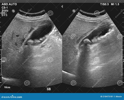 Gallbladder Ultrasound Stones