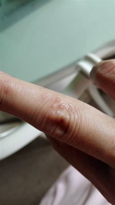水泡手癣 水泡型足癣 伤感说说吧