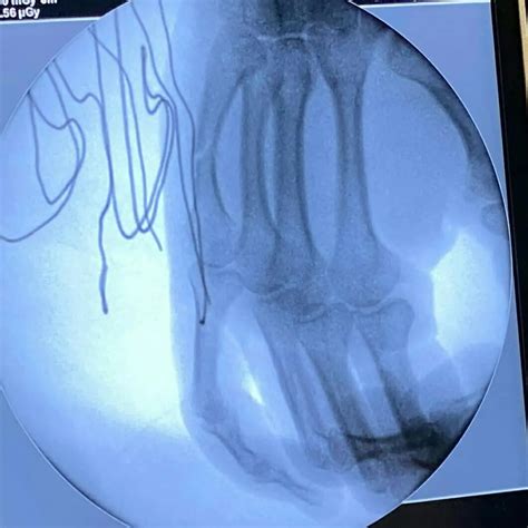 Fractura De La Base Del Quinto Metacarpiano
