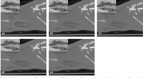 Figure 7 From A Denoising Algorithm For Projection Measurements In Cone Beam Computed Tomography