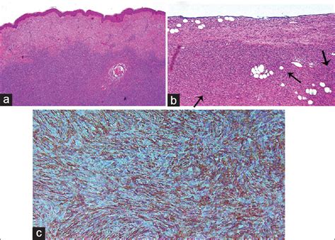 Dermatofibrosarcoma Protuberans Insights Into A Rare Soft Tissue Tumor Journal Of Clinical
