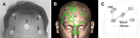 Development Of An Ultrafast Brain Mr Neuronavigation Protocol For Ventricular Shunt Placement Pmc