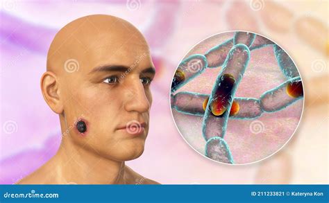 Cutaneous Anthrax The Most Common Form Of Anthrax Stock Illustration