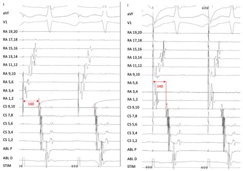 Electrogram Interpretation 3 Ep Essentials Electrogram Interpretation 3 Ep Essentials