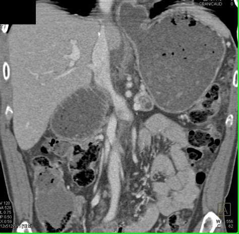 Obstruction Of The Gastrojejunostomy Loop Small Bowel Case Studies Ctisus Ct Scanning