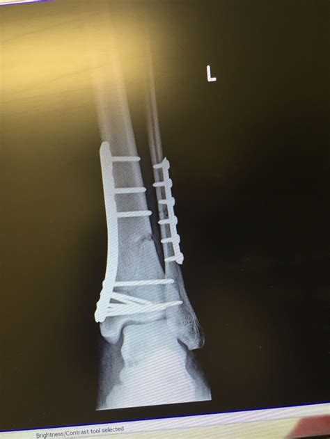 Spiral Fracture Of Tibia And Fibula Recovery Time PicksJuli
