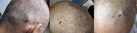 Multiple Reddish Nodules In The Subcutis Of The Scalp Download Scientific Diagram