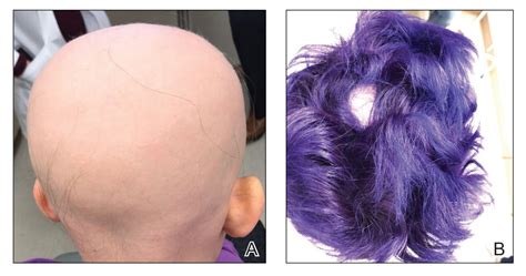 Adjuvant Scalp Rolling For Patients With Refractory Alopecia Areata MDedge Dermatology