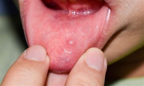 Mouth Pimple Inside At Karrie Keane Blog