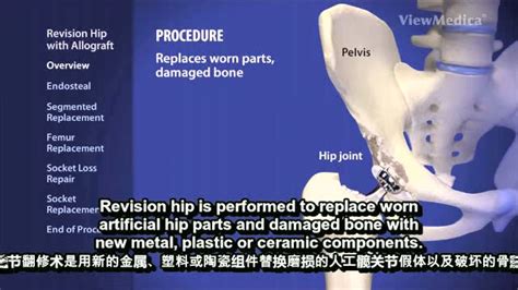 中英文字幕：使用同种异体骨移植进行髋关节翻修高清1080p在线观看平台腾讯视频