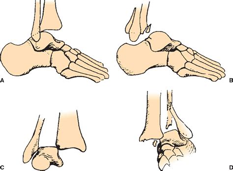 Ankle Dislocation And Reduction Anesthesia Key