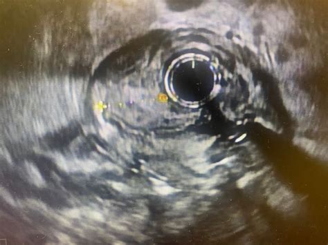 Rosario Ligresti Md Fasge On Linkedin First Case Today Was A 45 Yo Man With Linitis Plastica