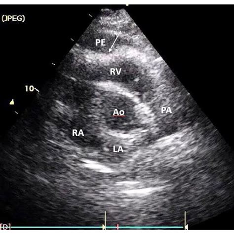 Case 2 Coronary Angiogram A Pre Pci Angiogram Revealed Lm