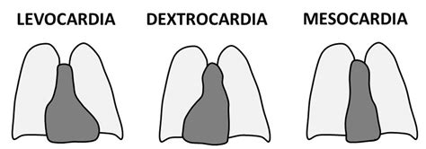 Segmental Approach To Congenital Heart Disease Clinical Tree