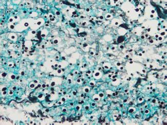 Histological Image Of Cryptococcus Spores Silver Stain Original Download Scientific Diagram