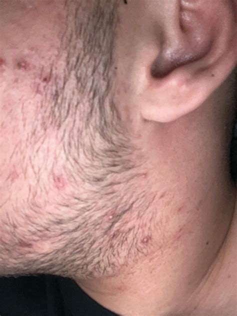 Ist Das Bart Oder Pflaum Jungs Wachstum Rasieren