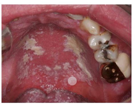 Viral And Fungal Infections Of The Mouth Flashcards Quizlet