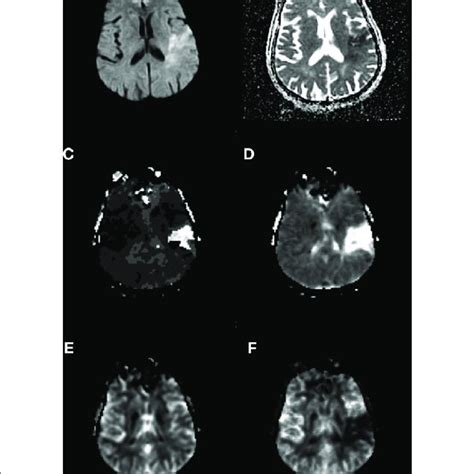 Trends Of Recanalization Rates In Tici Grade Of Each Three Devices Download Scientific Diagram