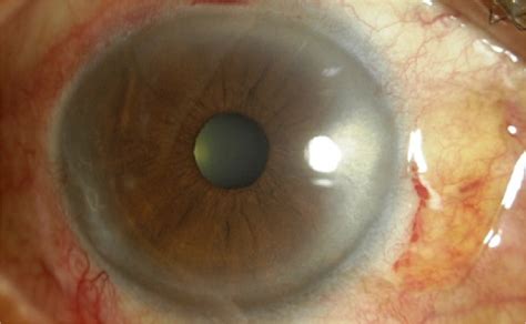Conjunctival Autograft At Day 1 Download Scientific Diagram