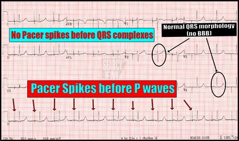 Paced Ekgs Searcy Em