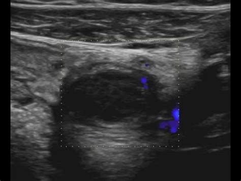 Abdomen And Retroperitoneum 1 5 Appendix Case 1 5 5 Mucocele Or