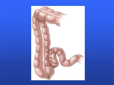 Intussusception Definition Online Presentation