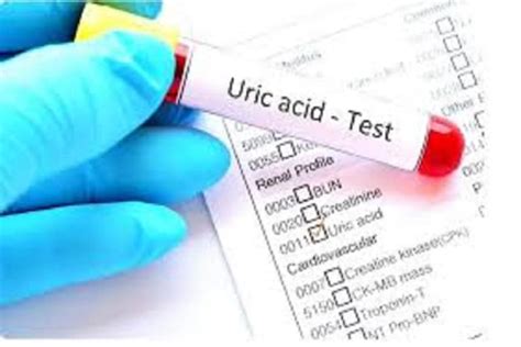 Uric Acid Control Tips যতই ইচ্ছে হোক মুখে তুলবে না মুসুরি বিউলি