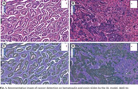 Figure 1 From Artificial Intelligence In The Pathology Of Gastric Cancer Semantic Scholar