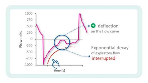 Using Waveforms To Identify Asynchronies Step 2 Hamilton Medical