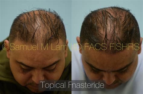 Minoxidil Results