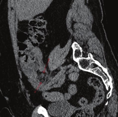 Tomografia Computadorizada Do Abdome Em Reconstrução Sagital Sem