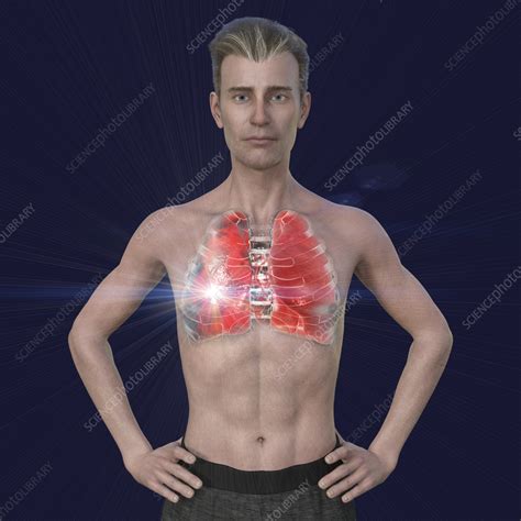 Man With Lungs Affected By Pneumonia Illustration Stock Image F041