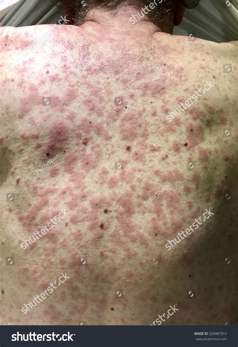 Maculopapular Rash Hiv