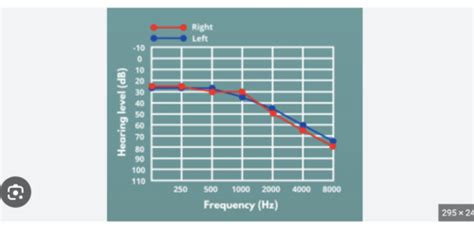 Audiogram Interpretation Flashcards Quizlet