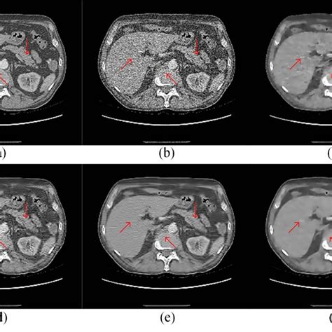 Pdf Low Dose Ct Via Convolutional Neural Network