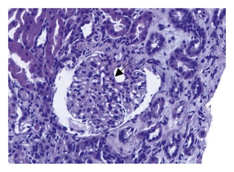 Light Microscopy Shows A Global Increase Of Mesangial Matrix With Download Scientific Diagram