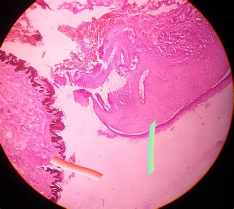 Balanitis Xerotica Obliterans Histology