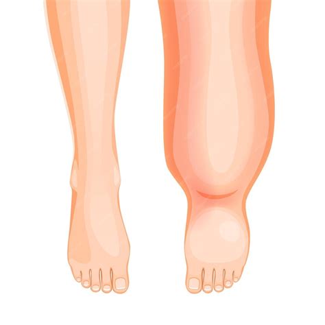 Premium Vector Edema Foot Disease Swollen Leg Symptom Or Problem