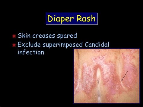 Common Neonatal Problems