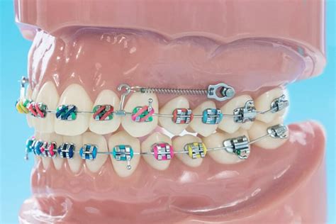 Springs In Braces Amazing Smiles Orthodontics