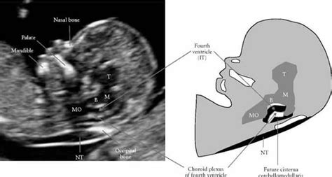 What Is Intracranial Ultrasound Guided Tips Facebook
