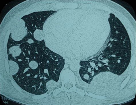 Computed Tomography Showing Multiple Pulmonary Nodules Download Scientific Diagram