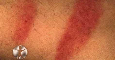Berloque Dermatitis Image