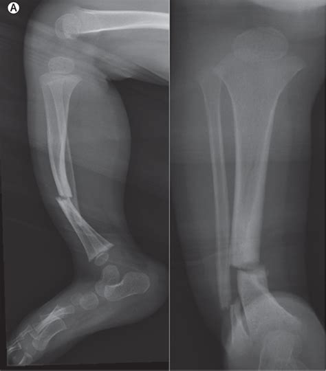 Pathologic Fracture X Ray