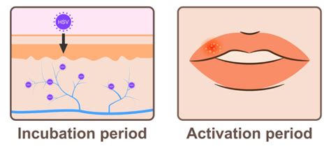 남자 여자 입술이나 생식기 수포 물집 포진 와 궤양 헤르페스 증상일 가능성 높아 네이버 블로그
