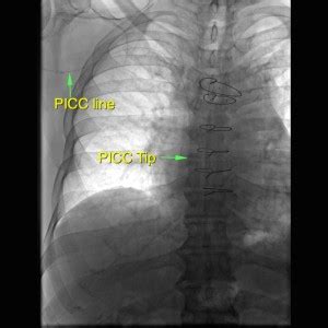PICC Line Sydney Medical Interventions