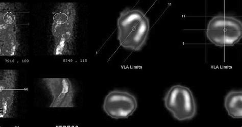Sinogram Lm Diagnostic