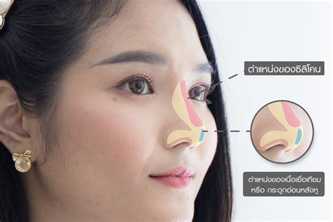เสริมจมูกกระดูกอ่อนหลังหู หรือ เนื้อเยื่อเทียม เลือกแบบไหนดี F Clinic คลินิกความงาม ครบวงจร